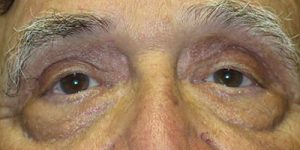Eyelid Lesion Removal Houston TX, Ophthalmic Plastic Surgeons of Texas