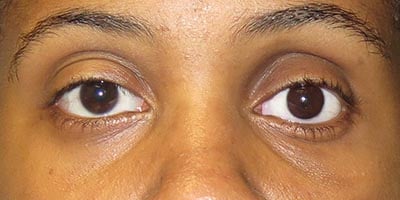 Enucleation Photos Houston TX, Ophthalmic Plastic Surgeons of Texas
