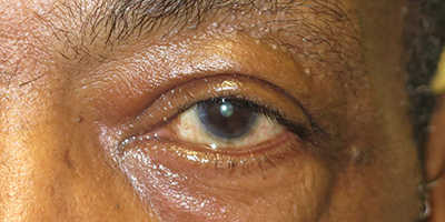 Eyelid Lesion Photos Houston TX, Ophthalmic Plastic Surgeons of Texas