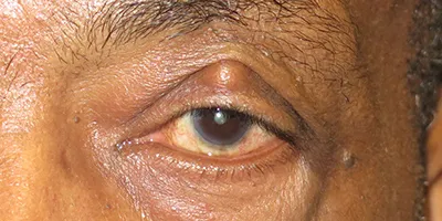 Eyelid Lesion Photos Houston TX, Ophthalmic Plastic Surgeons of Texas