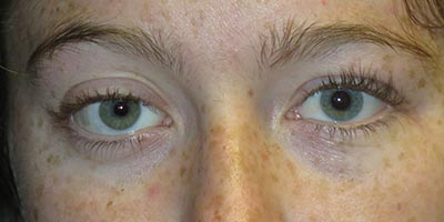 Eyelid Malposition Repair Houston TX, Ophthalmic Plastic Surgeons of Texas