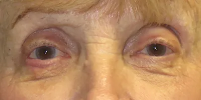 Skin Cancer Photos Houston TX, Ophthalmic Plastic Surgeons of Texas